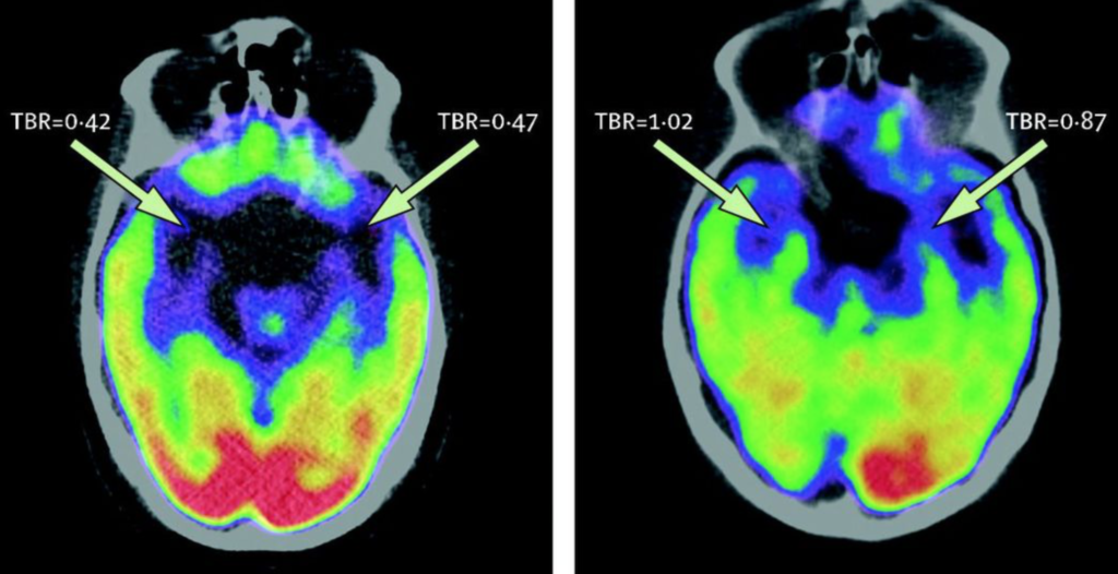 Stress Affects Health of Brain and Heart, Study Reveals